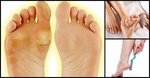 How to Get Rid of Calluses | Dr Farrah MD